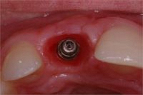 ΕΜΦΥΤΕΥΜΑΤΑ – DentalLabOrama.gr