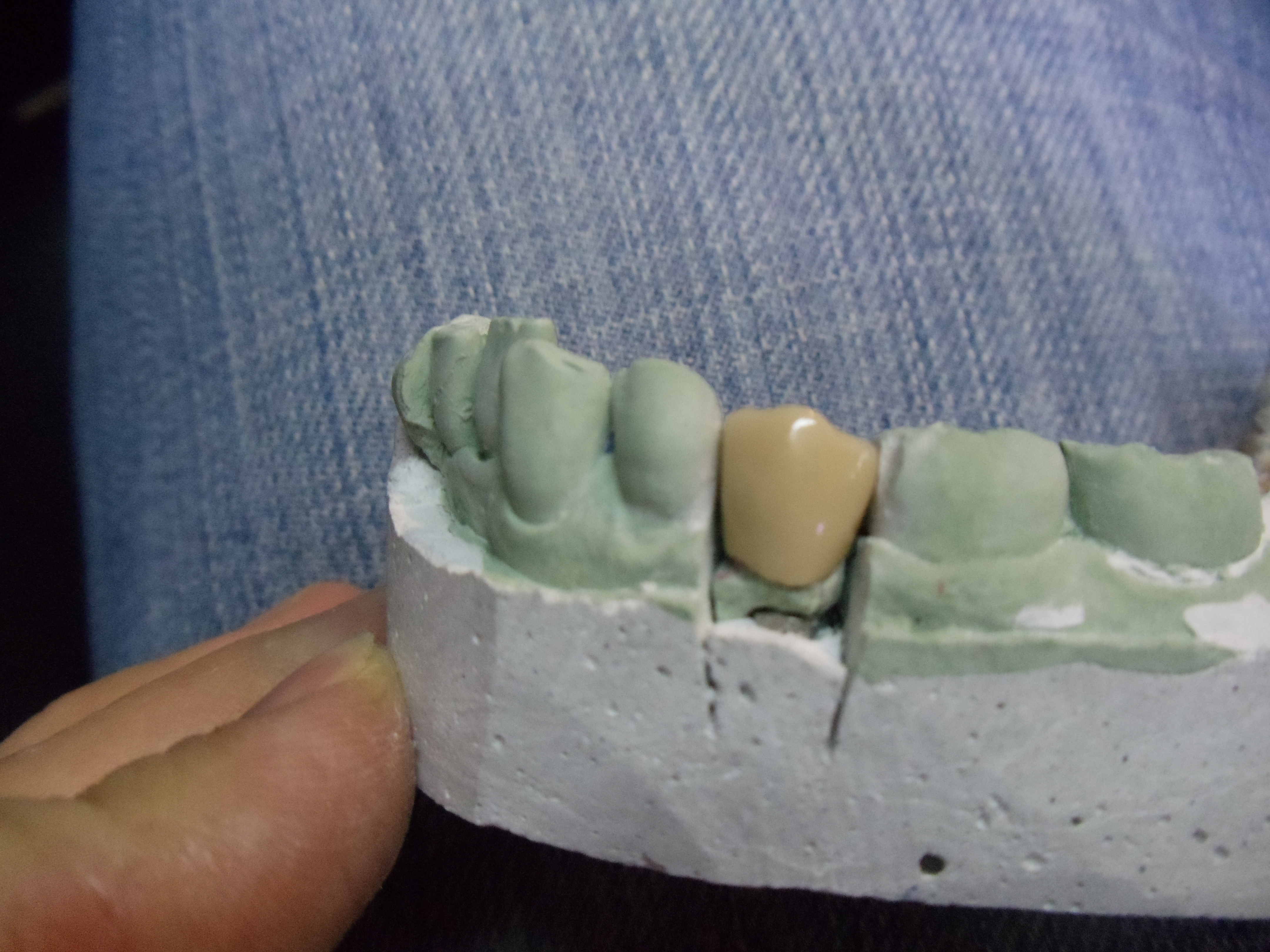 ΜΕΤΑΛΛΟΚΕΡΑΜΙΚΗ – DentalLabOrama.gr