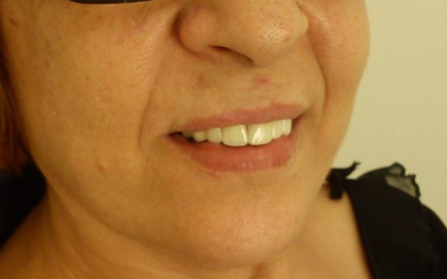 ΕΡΓΑΣΙΕΣ ΤΟΠΟΘΕΤΗΜΕΝΕΣ ΣΤΟ ΣΤΟΜΑ – DentalLabOrama.gr